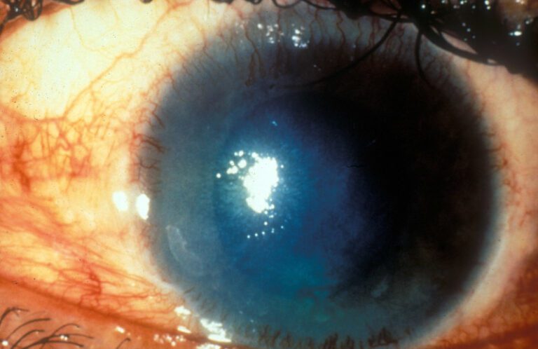Queimadura ocular: classificação, sintomas e tratamento!