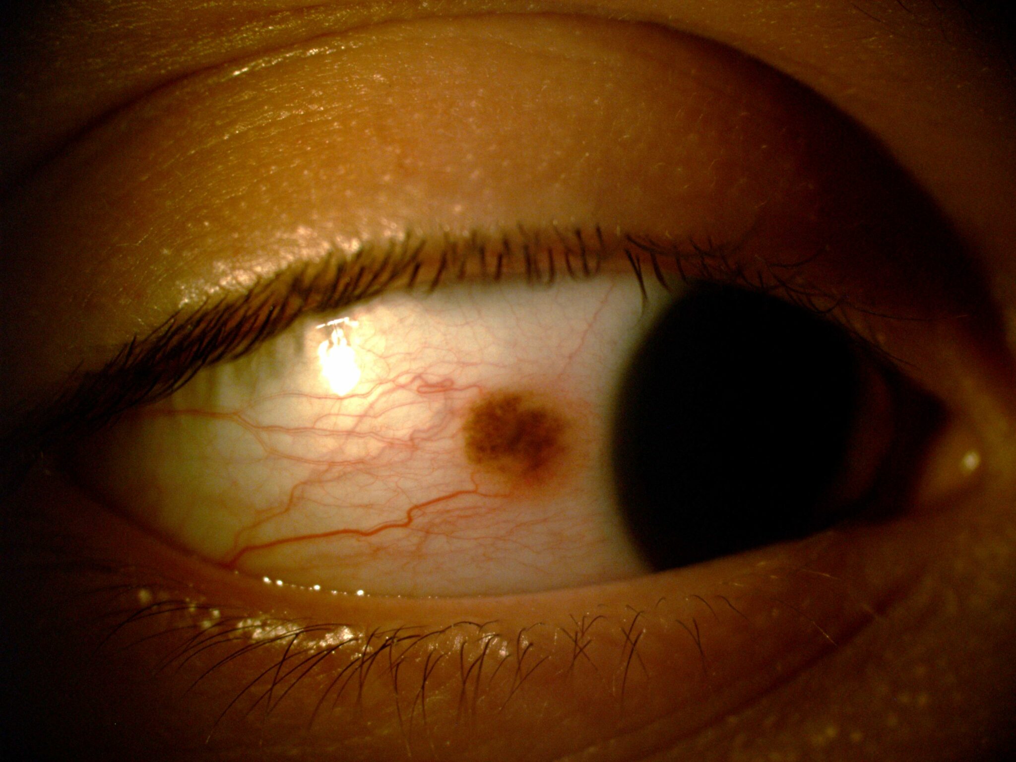 Tumores melanocíticos: entenda os principais diagnósticos