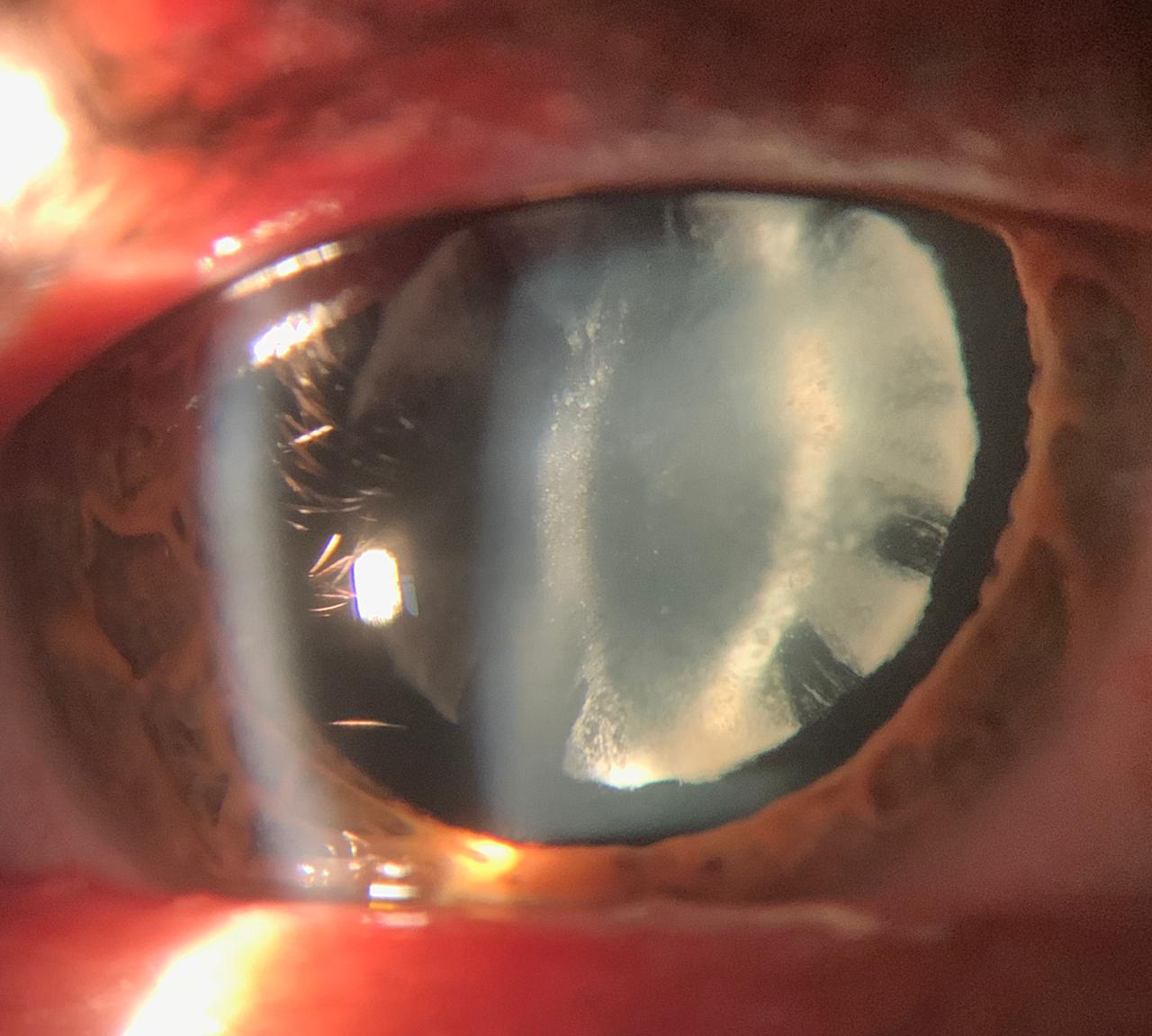 Catarata traumática: o que é, causas, tipos e tratamento