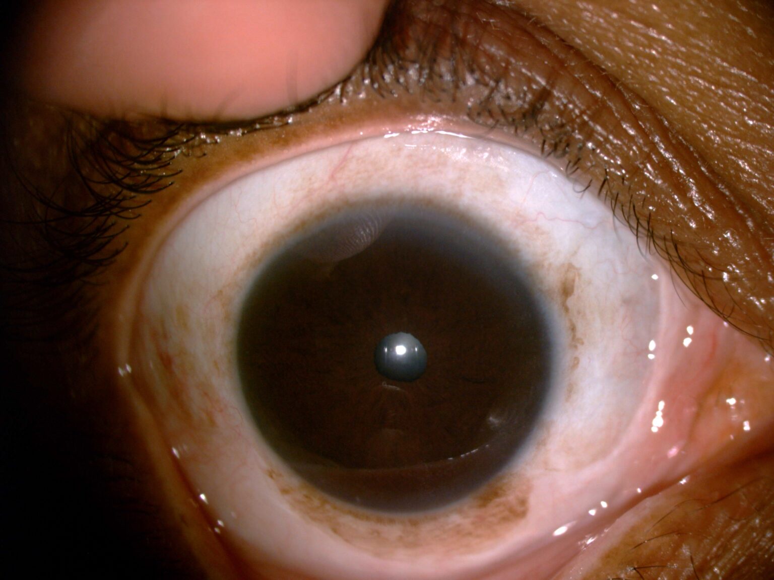 Tumores melanocíticos: entenda os principais diagnósticos