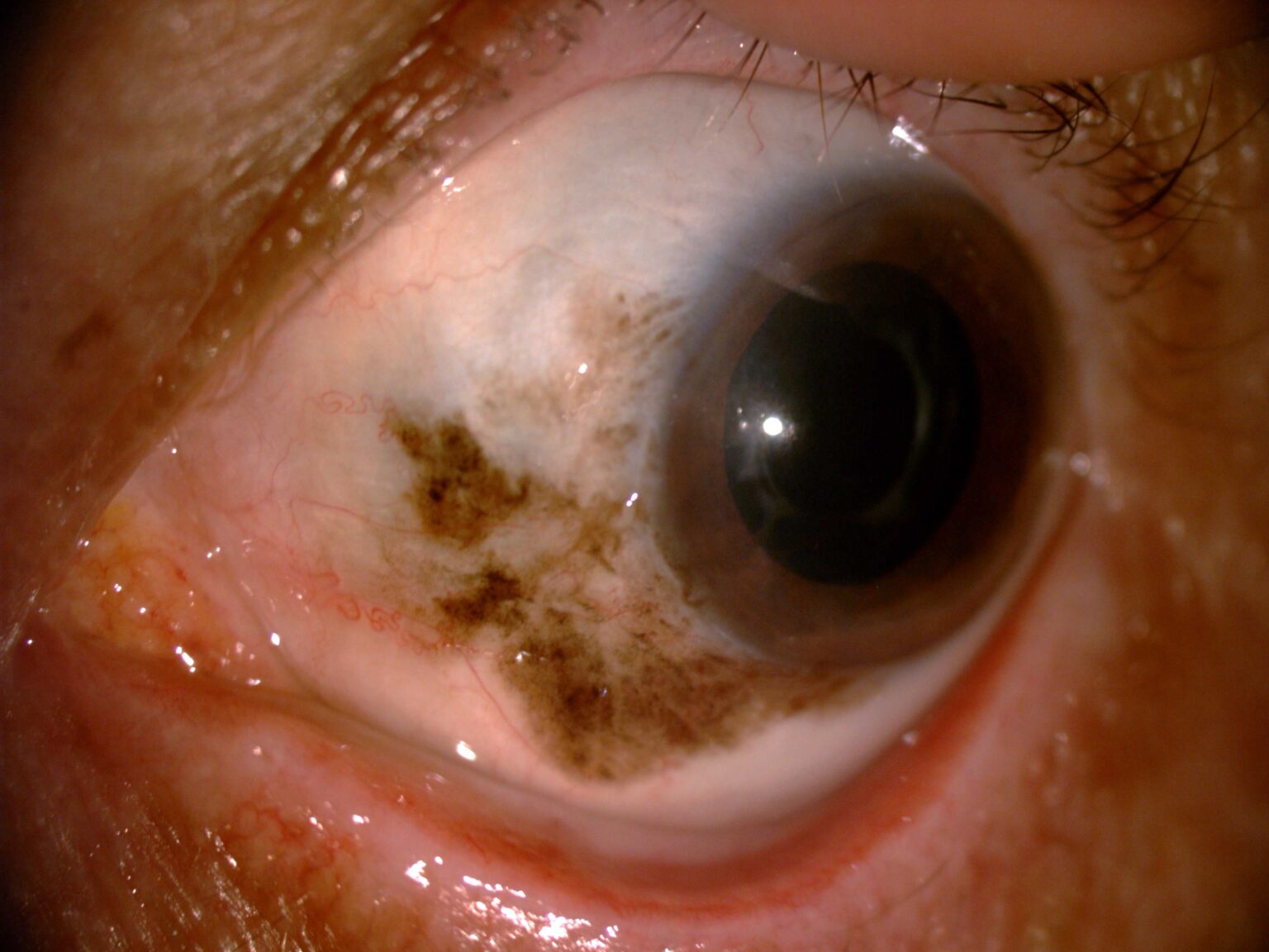 Tumores melanocíticos: entenda os principais diagnósticos