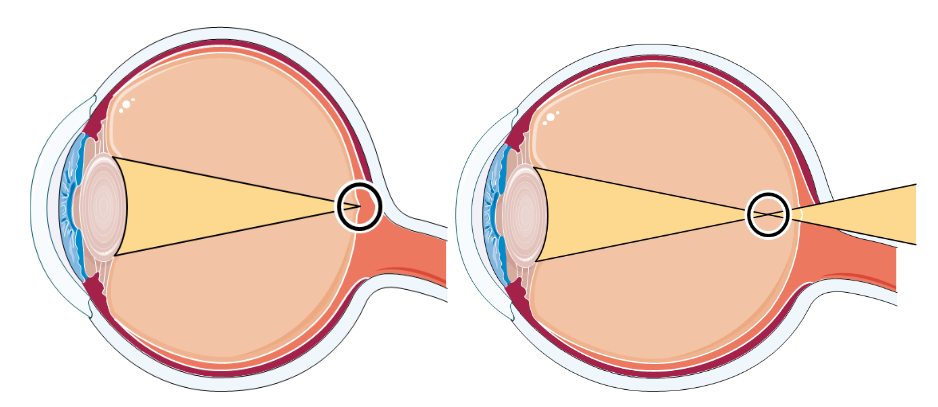 Grau de miopia: quando é considerado cegueira?