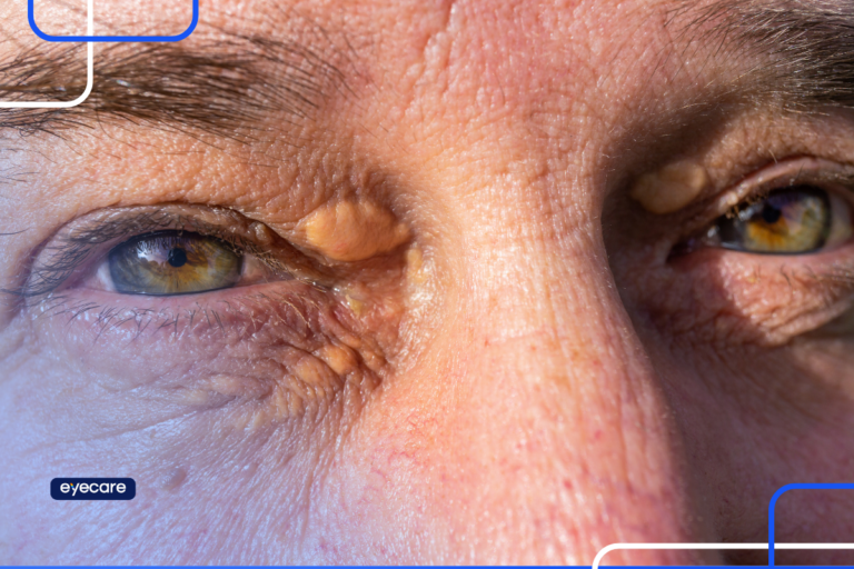 Xantelasma: tratamento e remoção para melhoria estética