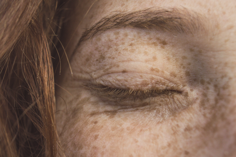 Olhos saltados (proptose ocular): o que significa e quando é sinal de ...