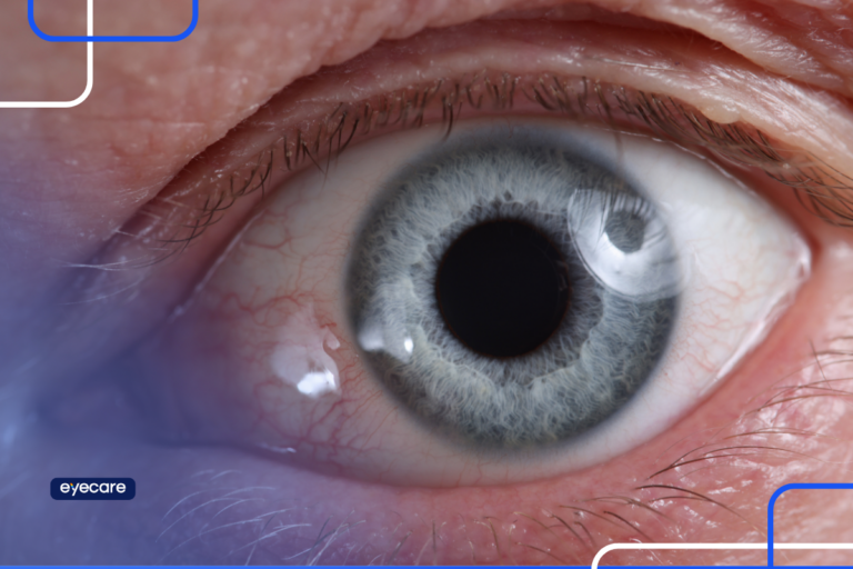 Olhos saltados (proptose ocular): o que significa e quando é sinal de ...